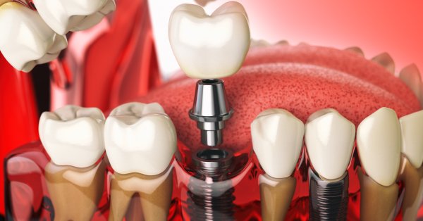 Dental Implants in Washington: Foods to Avoid After Surgery